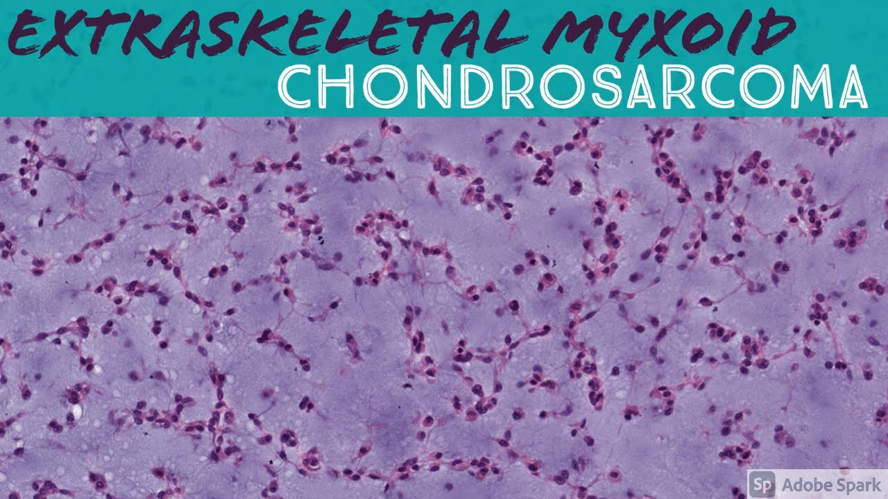 Extraskeletal Myxoid Chondrosarcoma: 5-Minute Pathology Pearls - YouTube