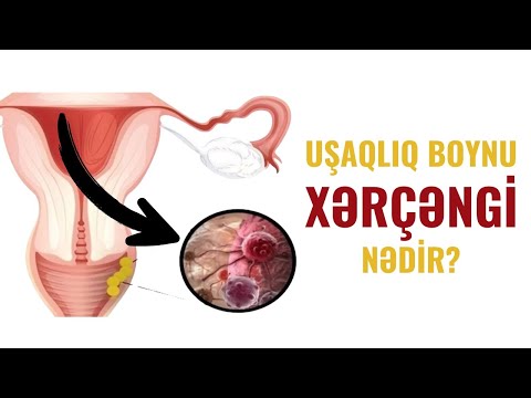 Uşaqlıq boynu xərçənginin əlamətləri və erkən aşkarlanması