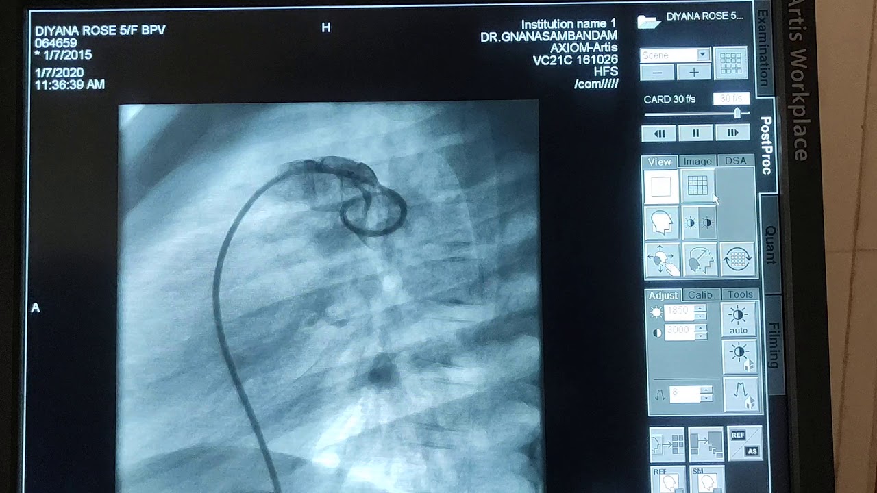 Balloon Pulmonary Valvotomy - YouTube