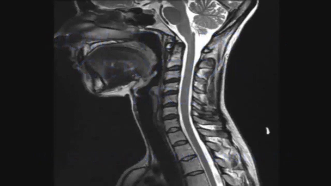 How To Do A Cervical Mri Youtube