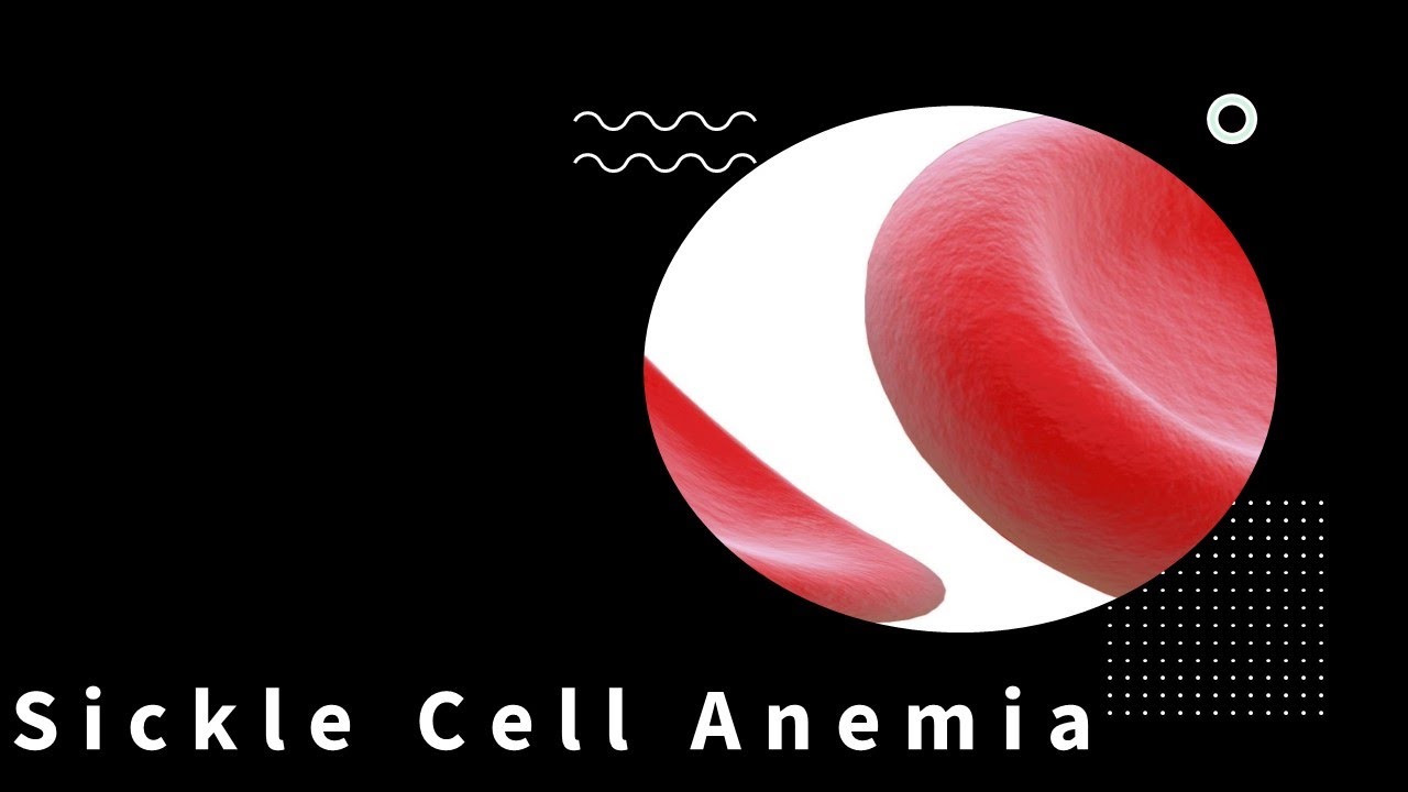 Sickle Cell Anemia :HbS, Sickle Cell Disease, Sickle Cell Trait ...
