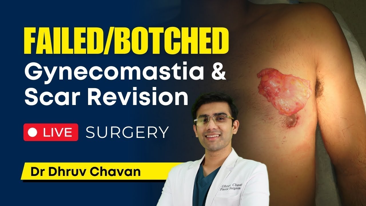 Failed Gynecomastia Surgery Fixed! | Live Redo & Scar Revision ...