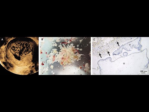 Vollständige hydatidiforme Blasenmole - YouTube