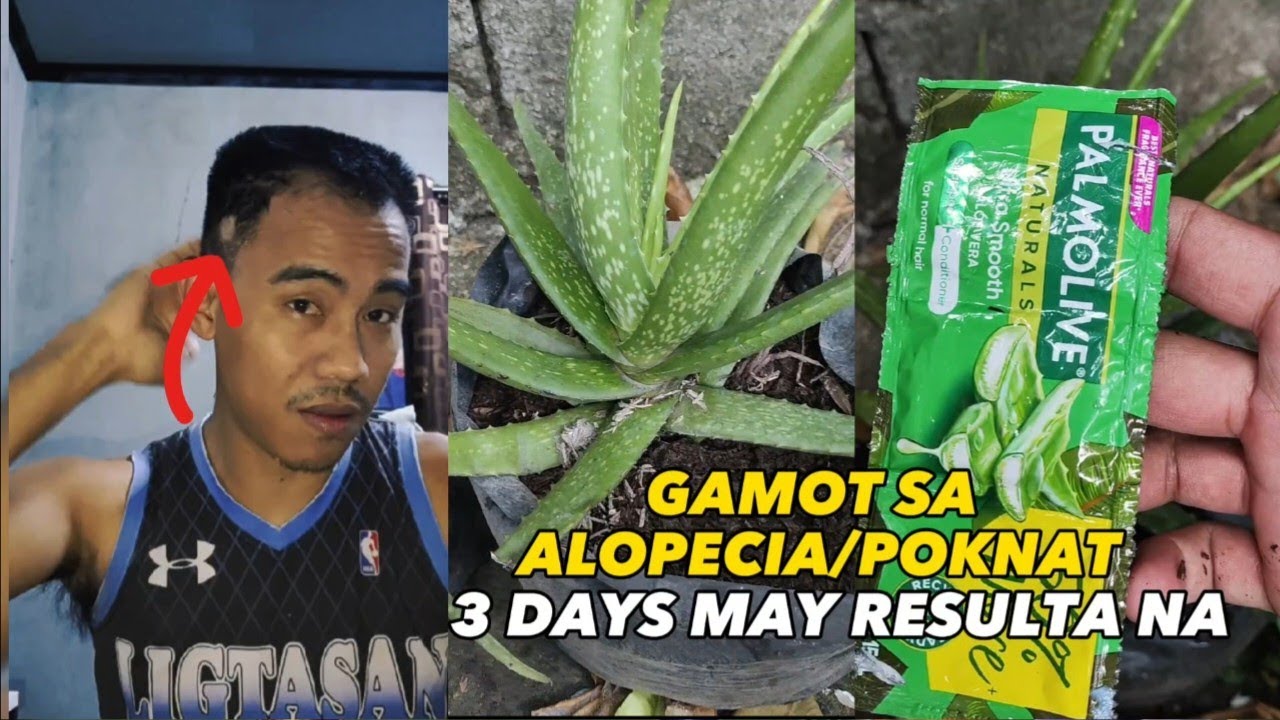 GAMOT SA ALOPECIA/POKNAT 3 DAYS MAY TUMUTUBO NA AGAD NA BUHOK - YouTube