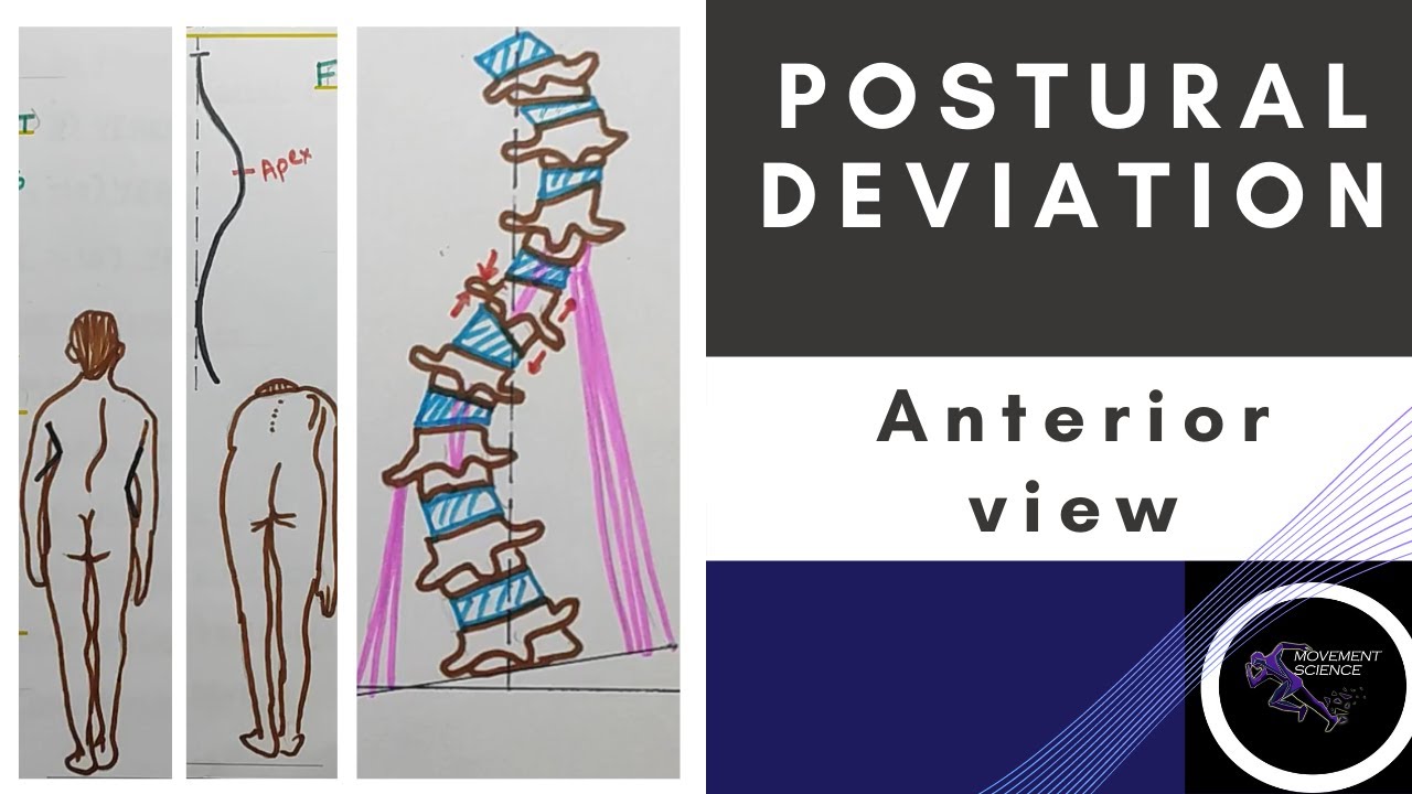 POSTURAL DEVIATION IN FRONTAL PLANE- SCOLIOSIS (Posture Biomechanics ...