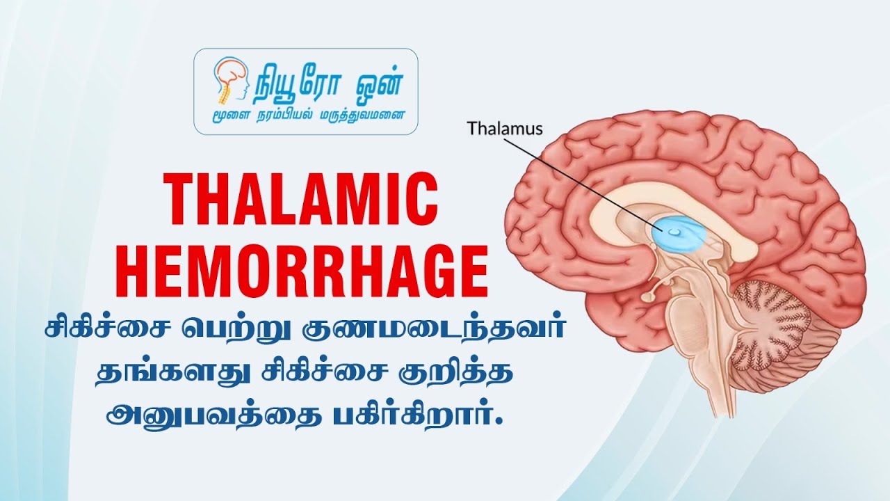 Thalamic Hemorrhage Recovery | Treated by Dr. K. Aruna Ramani | Walking ...