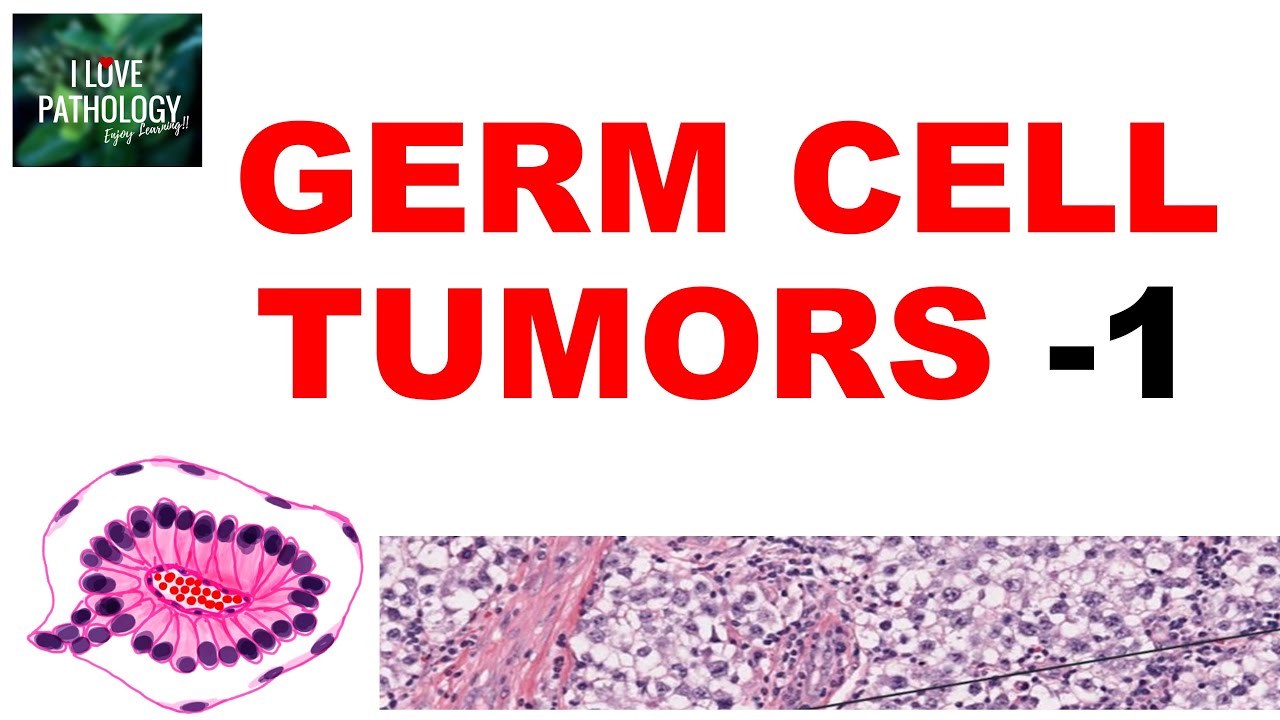 OVARIAN TUMORS - Part 4: Germ cell tumors: Dysgerminoma, yolk sac tumor - Pathology - YouTube