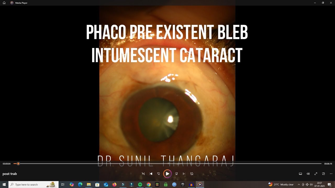 Phaco in an intumescent cataract with a pre existent bleb - YouTube