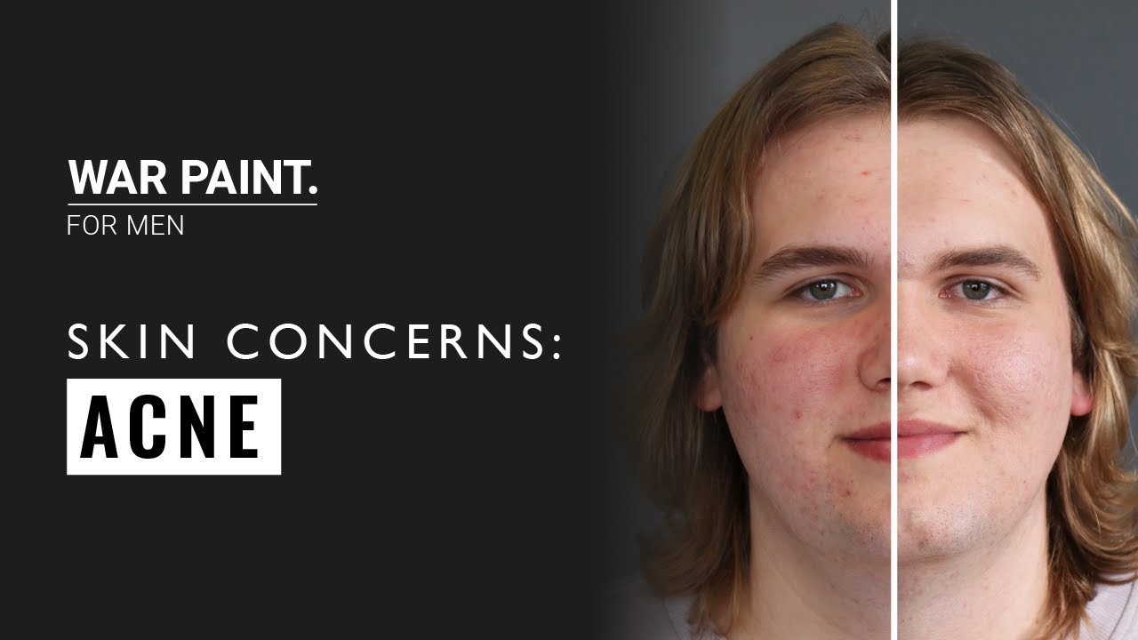 TACKLING COMMON SKIN CONCERNS | ACNE - YouTube