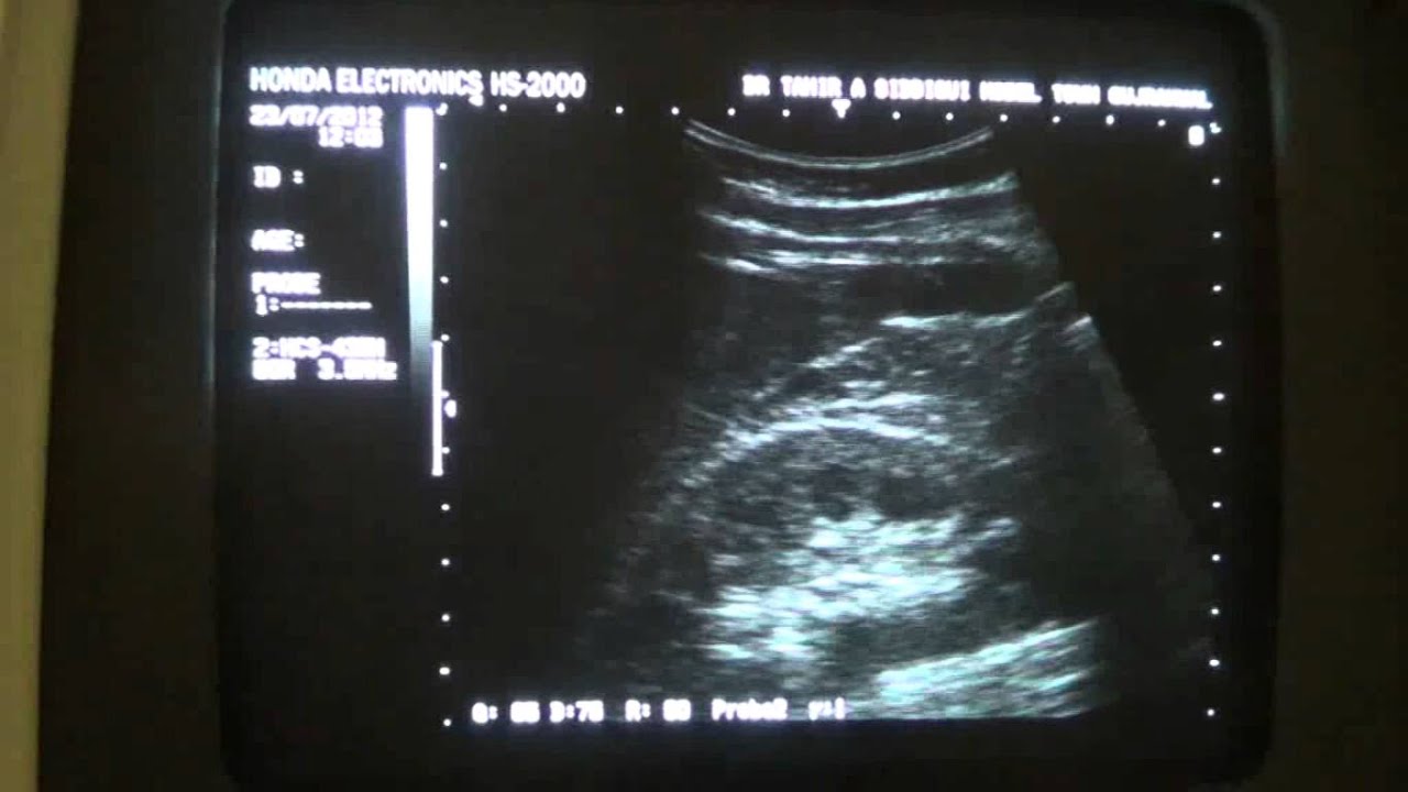 prominent renal pyramids vs simple renal cyst - YouTube