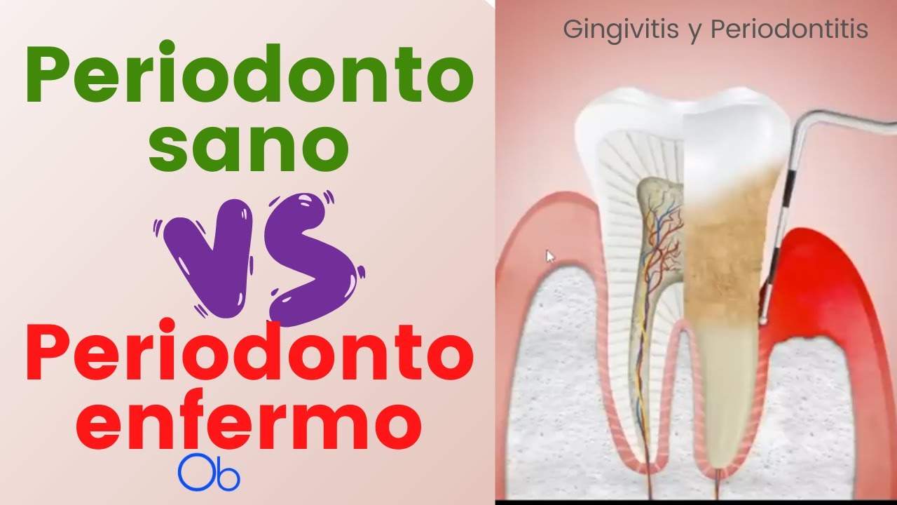 Periodonto sano vs Periodonto enfermo - YouTube