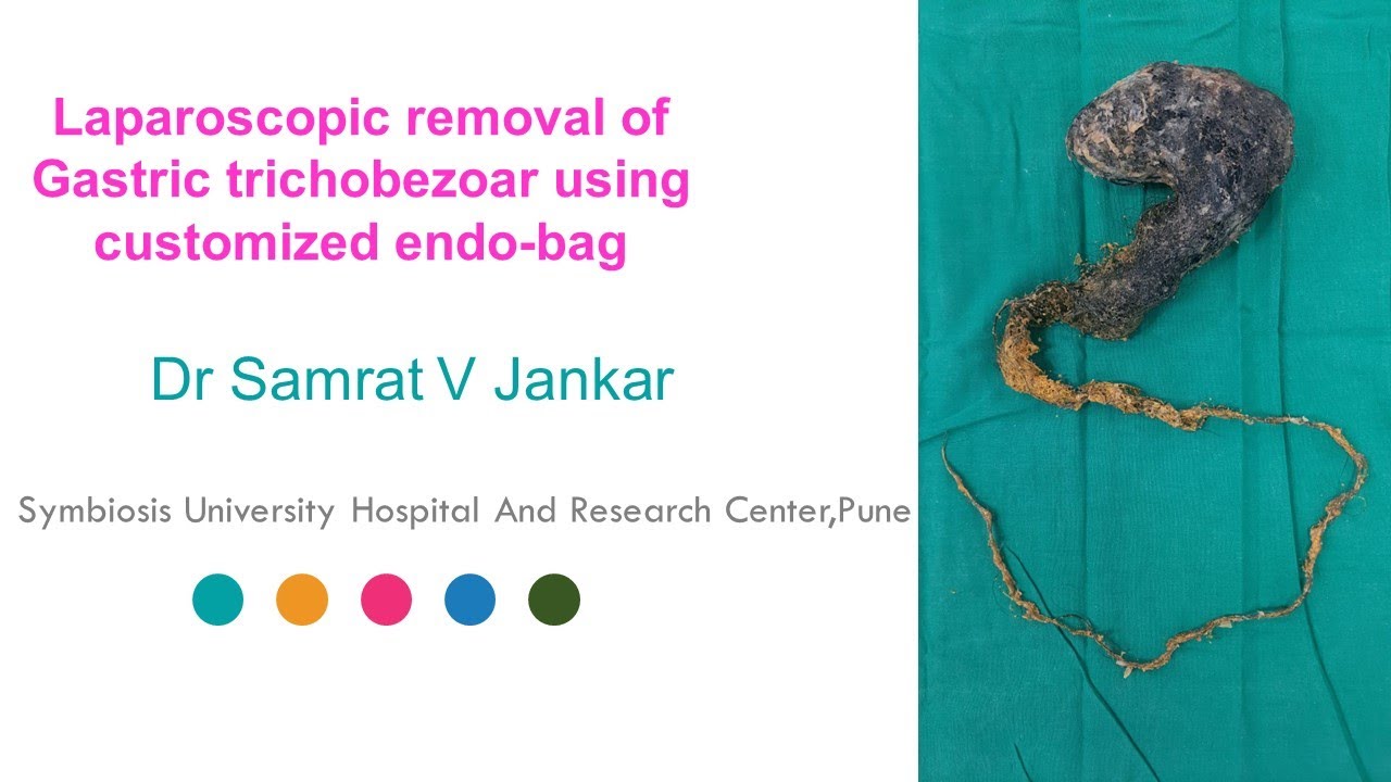 Laparoscopic removal of Gastric trichobezoar using customized endo-bag ...