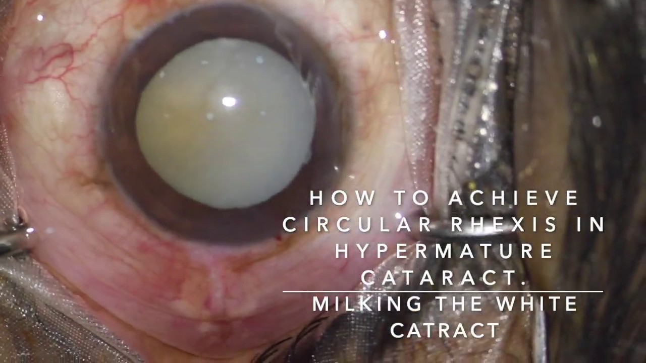 Hypermature White Cataract Rhexis - YouTube