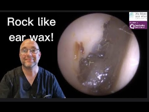 Rock like ear wax - Episode 65 #earwaxremoval - YouTube
