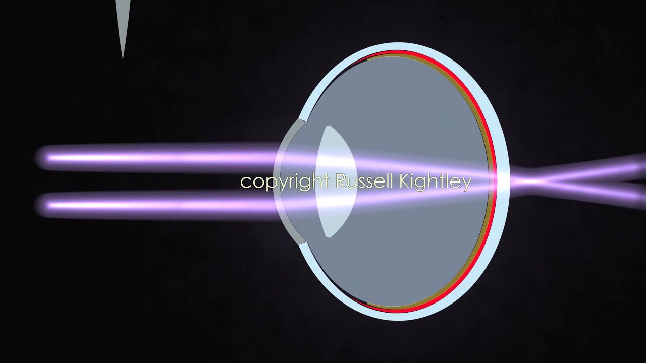 EYE hypermetropia animation by Russell Kightley - YouTube