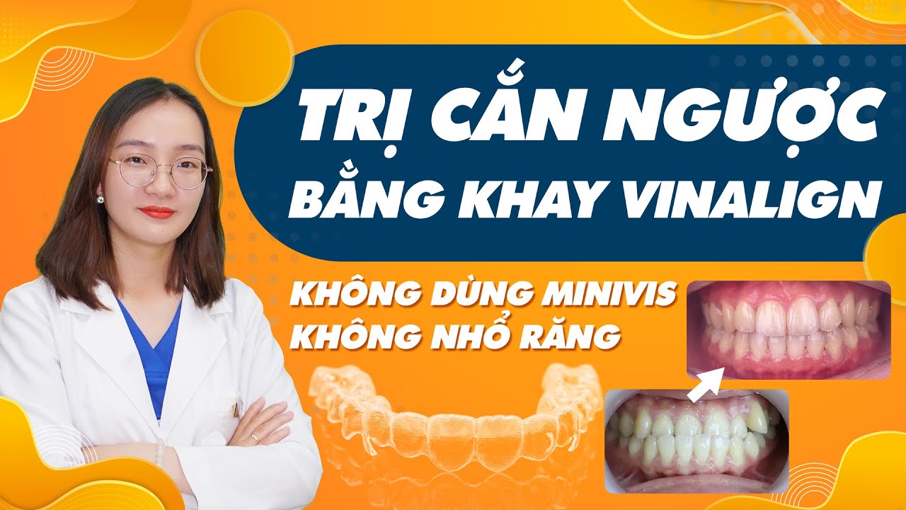 Niềng Răng Khay Trong Suốt Vinalign Điều Trị Khớp Cắn Ngược | Nam Bùi Vinalign - YouTube