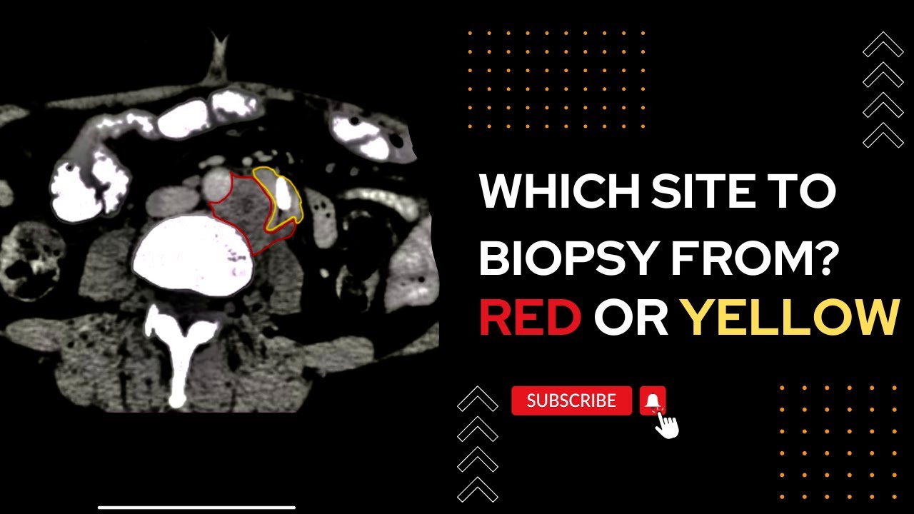 Biopsy Site Selection: Maximizing Sample Yield by Differentiating ...