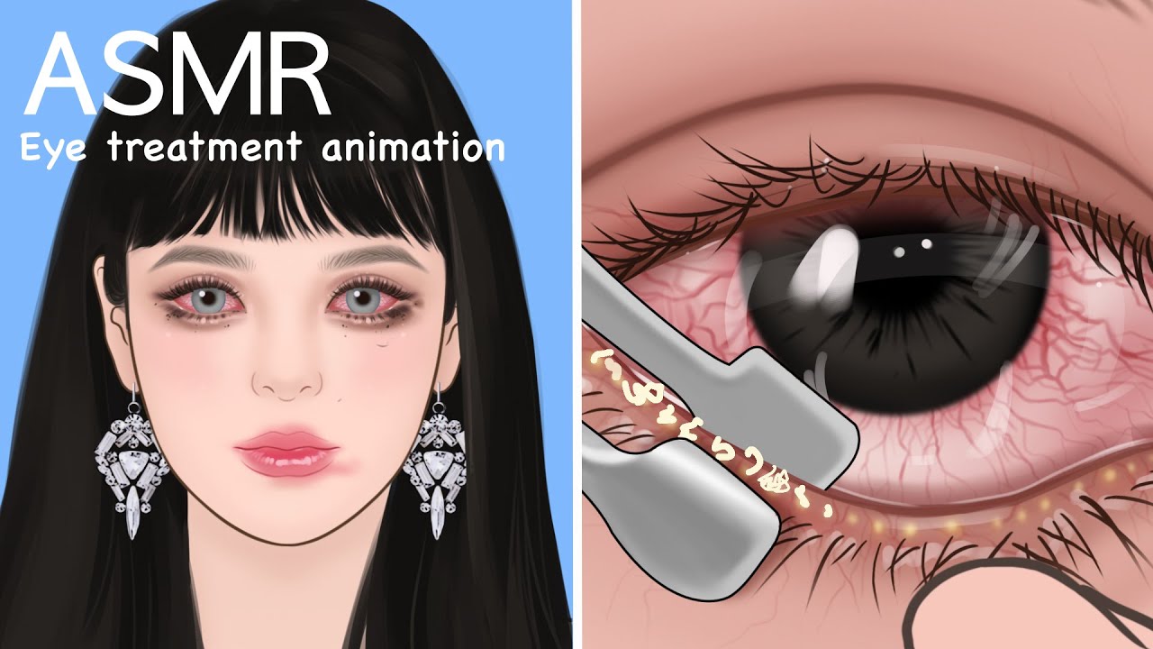 ASMR Eyelid Sebum Extrusion Animation / Extracting a Milia under the ...