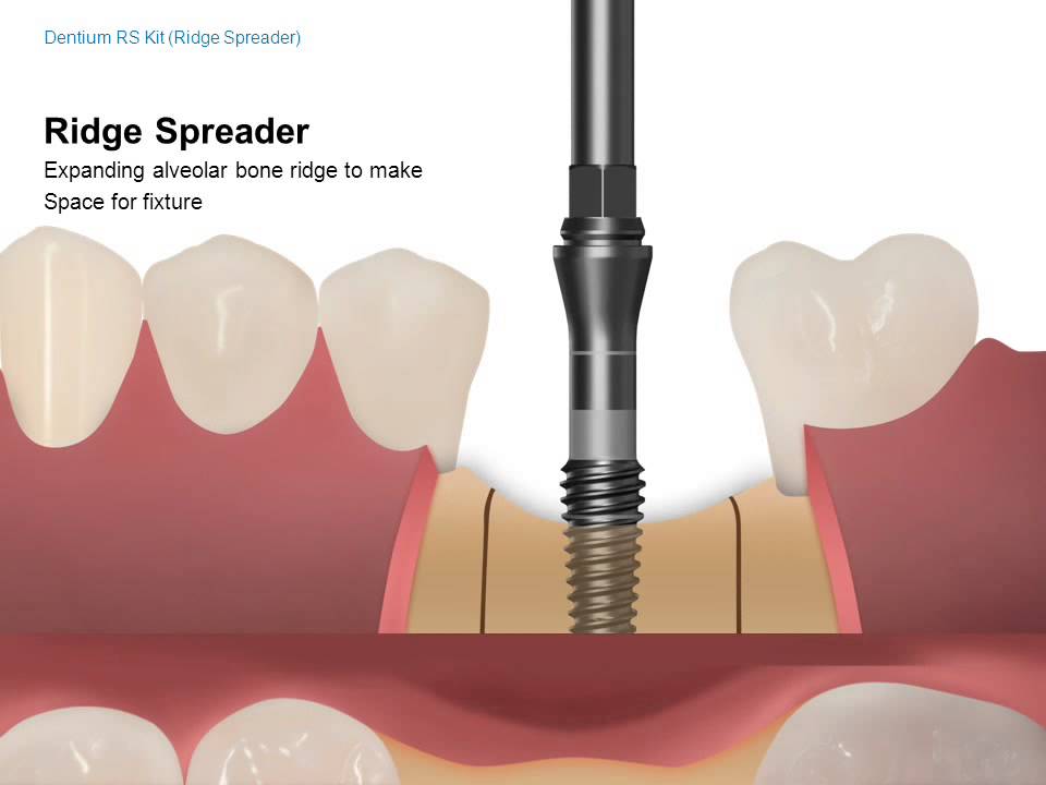 2D Manual Ridge Spreader - YouTube