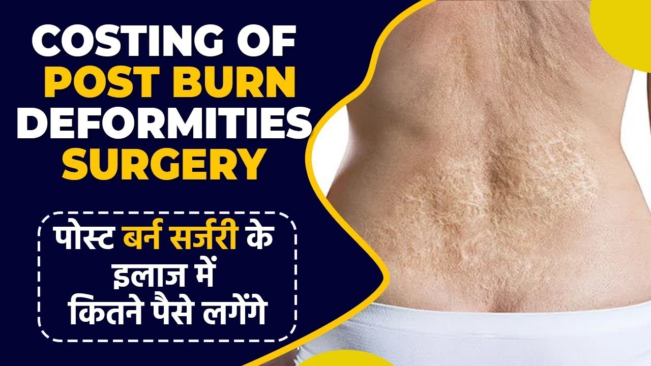 Cost of Post Burn Surgery, Contracture Treatment, Grafting ...