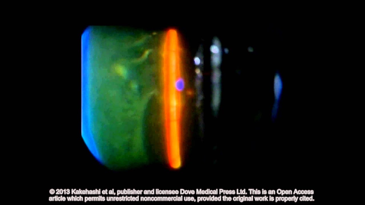 Posterior Vitreous Detachment Slit Lamp