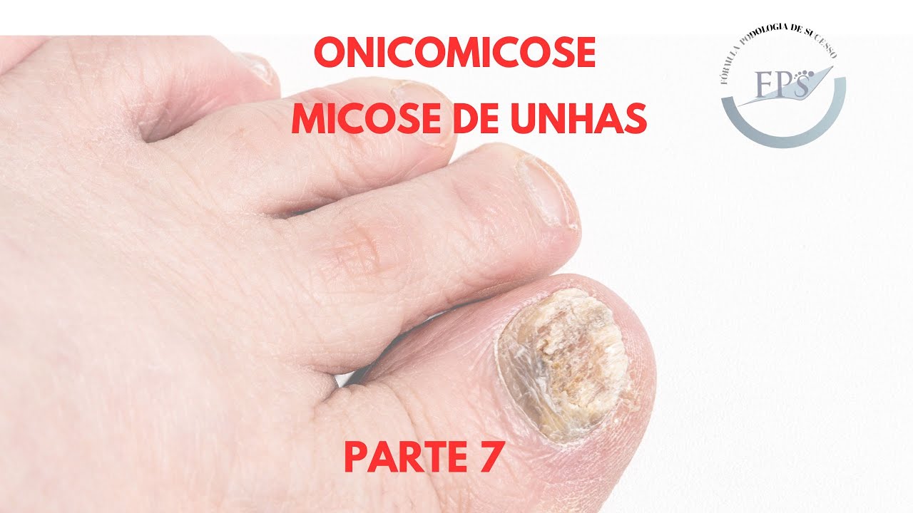 Onicomicose - Micose de Unha - Parte 7 - Como Tratamento - YouTube