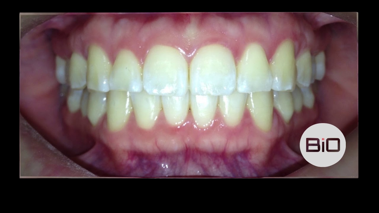 Correction of smile arc - YouTube