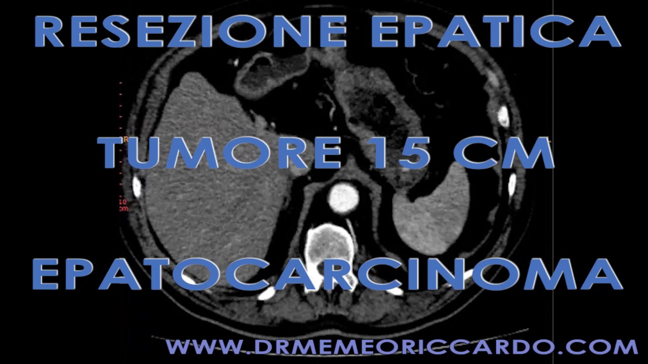 Liver resection segment 6 hepatocellular carcinoma on NASH - YouTube