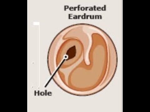 Tympanoplasty for ear drum perforation - YouTube