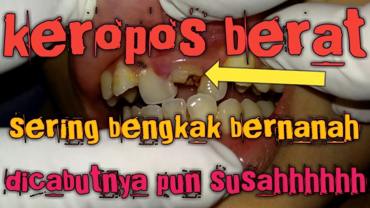 Gigi depan atas keropos berat,berpolip dan gusi sering bengkak bernanah ...