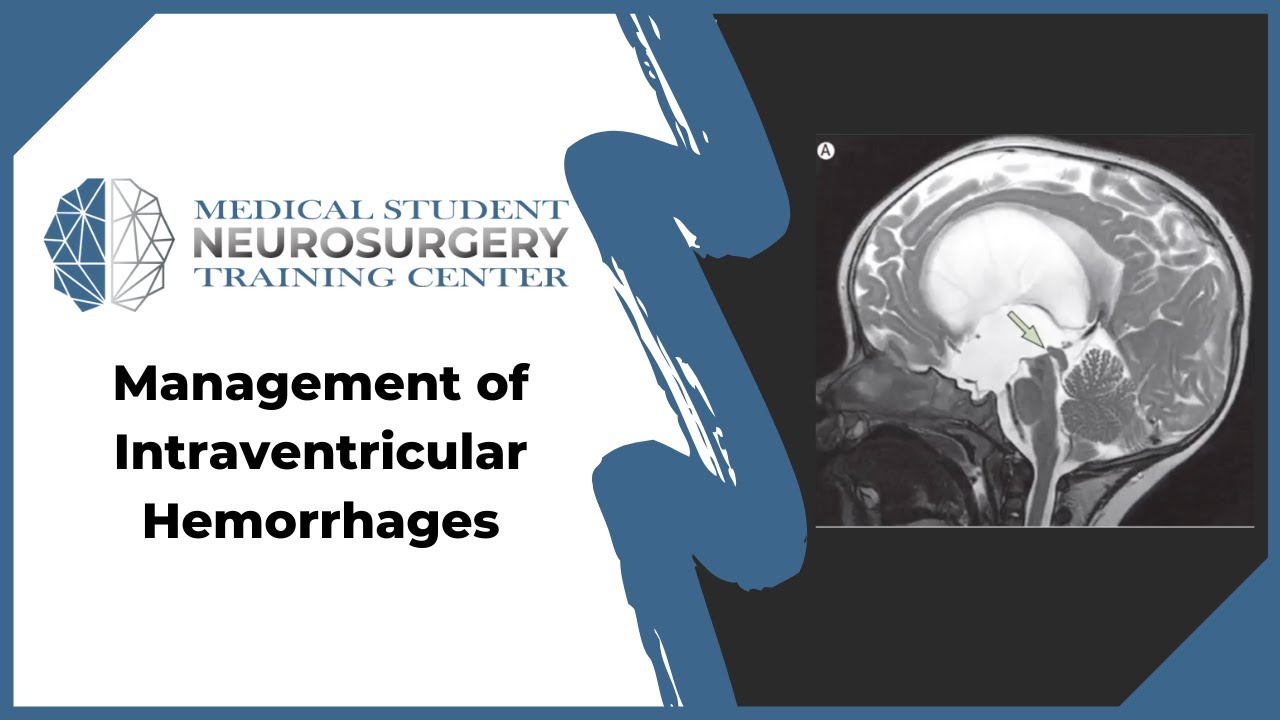 Management of Intraventricular Hemorrhages - YouTube