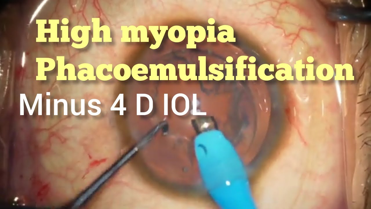 high myopia with minus 4 D IOL implantation - YouTube