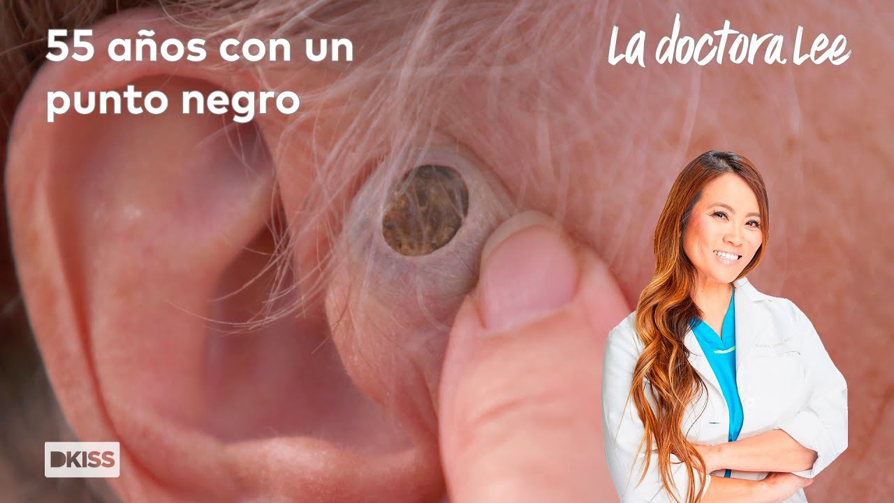 El punto negro más grande que ha extirpado la doctora Lee | La doctora ...