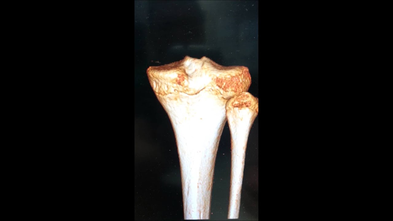 Knee/Tibia 3D Cat scan recon. - YouTube