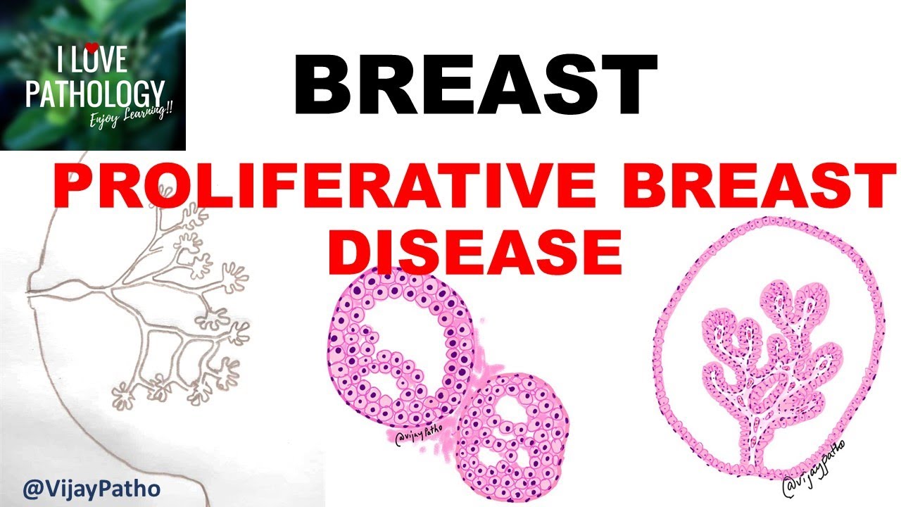Breast Disease