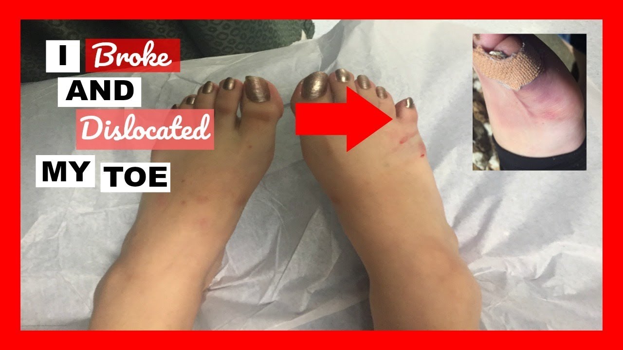 I Broke And Dislocated My Toe | Hospital Story - YouTube