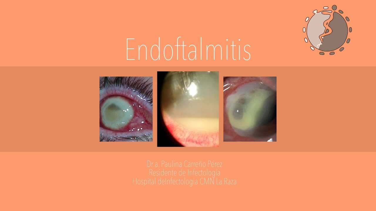 Endoftalmitis - YouTube