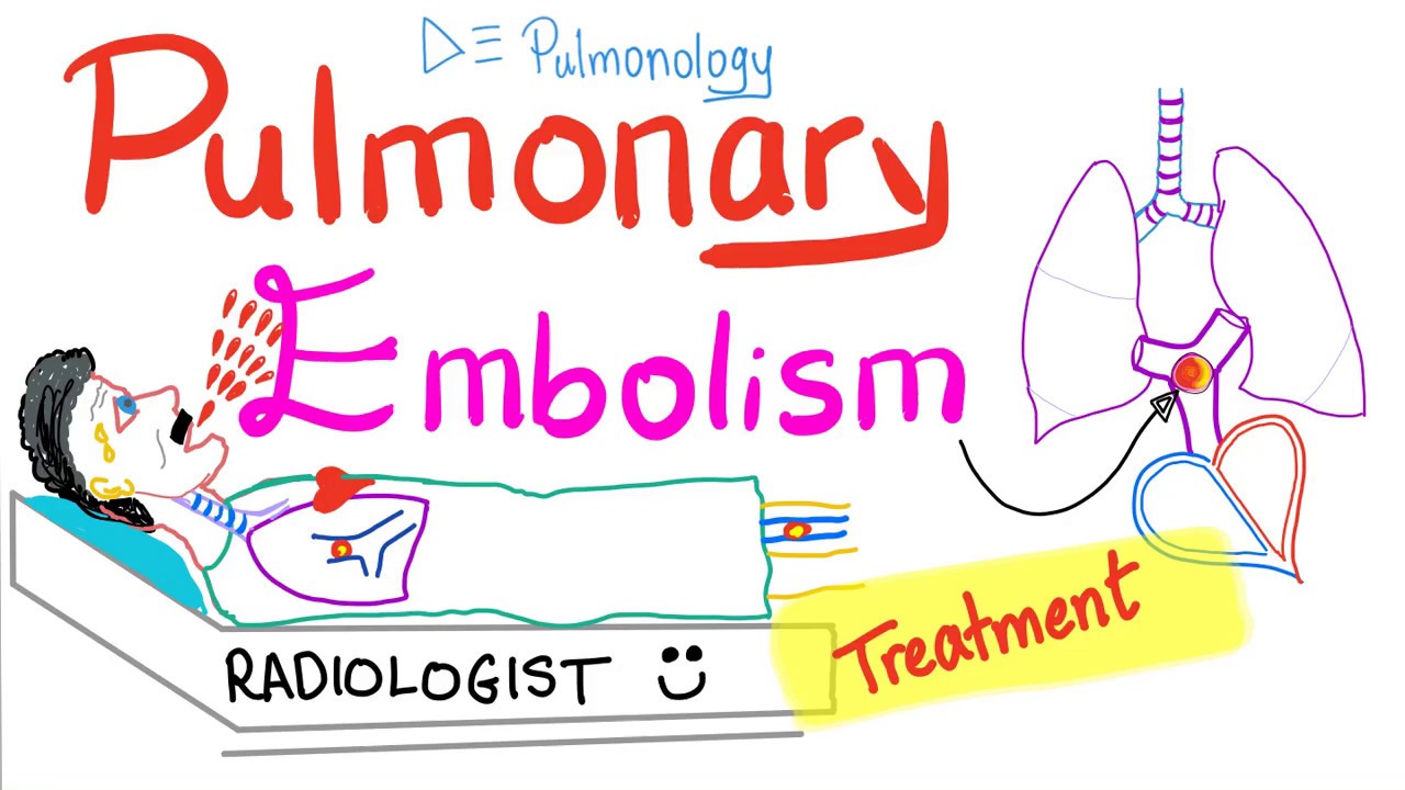 Pulmonary Embolism Treatment