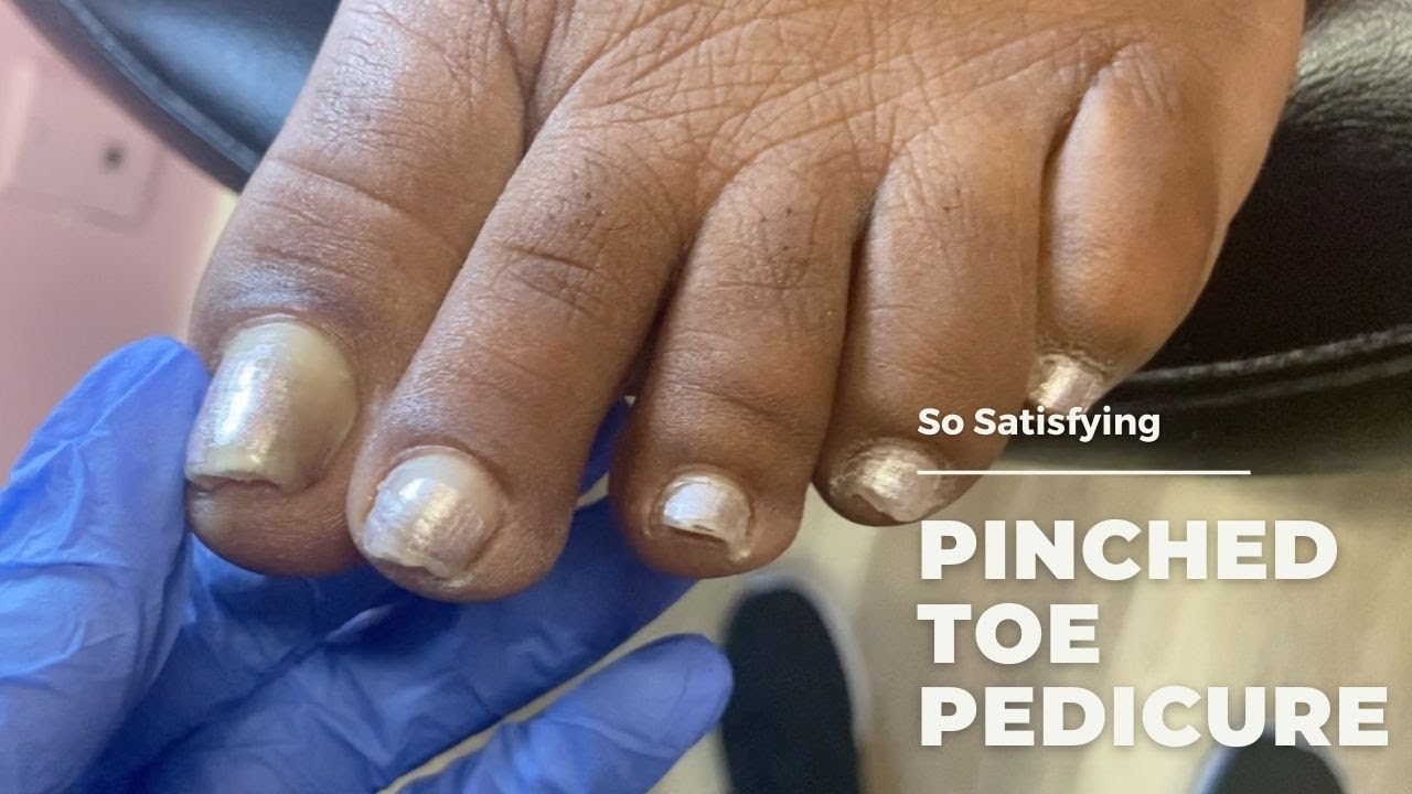 Pedicure on Pinched Toes - So Satisfying - YouTube
