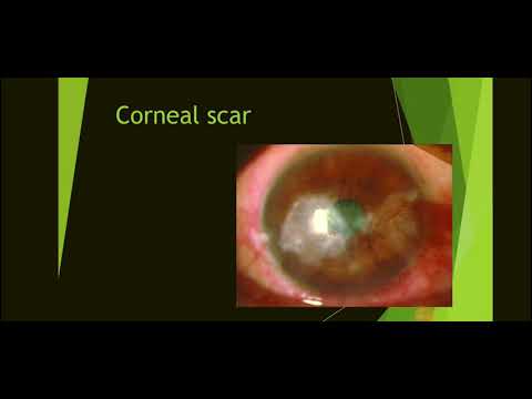 Corneal scar #eye #optometry - YouTube