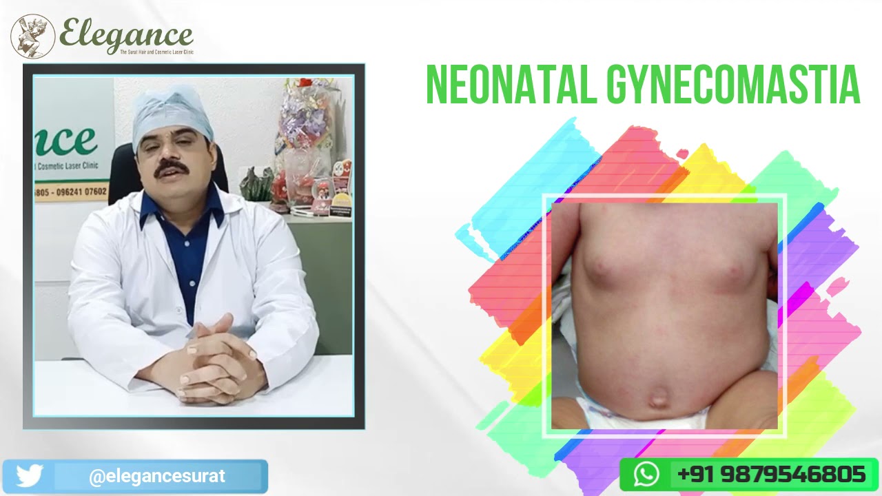 Neonatal Gynecomastia, Breast Enlargement of the Newborn, बच्चो की ...