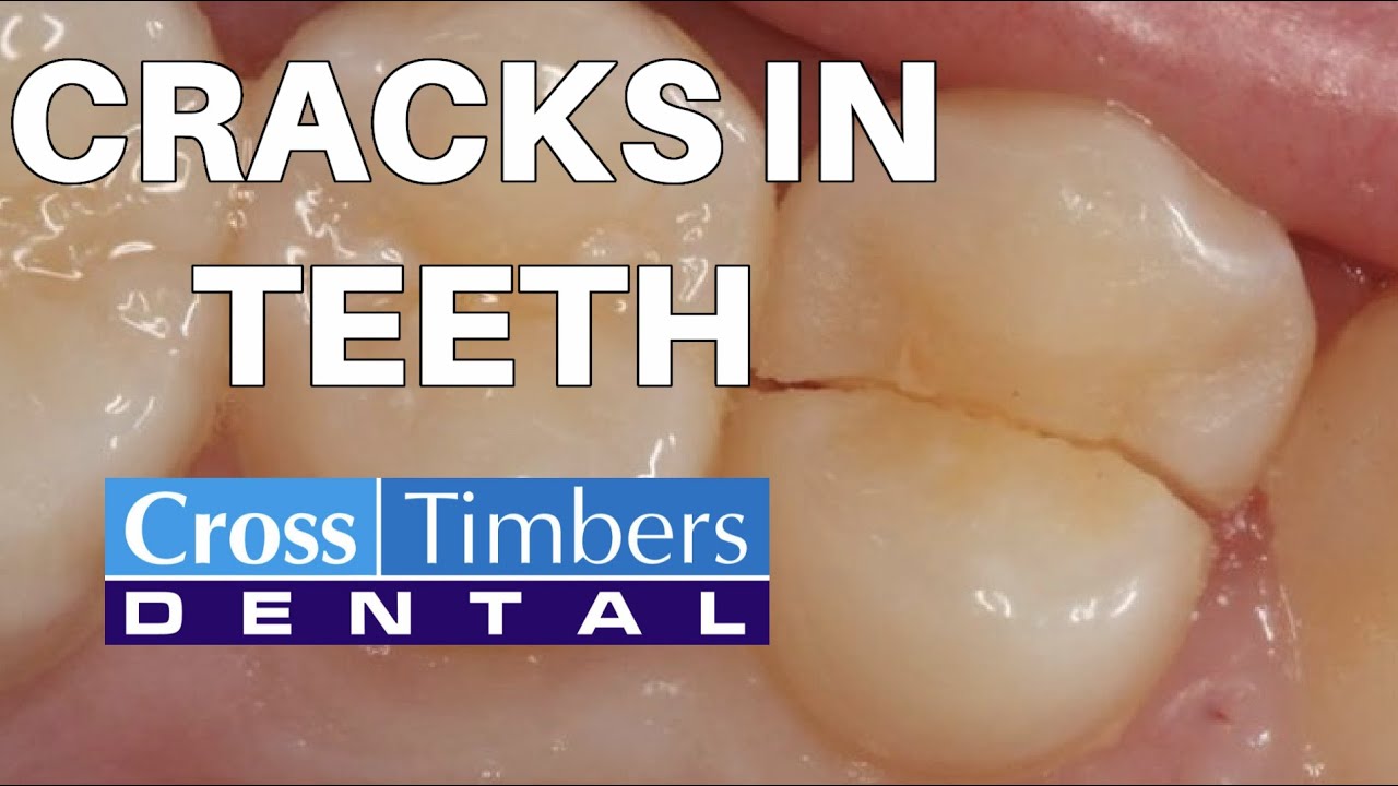 Cracks in teeth & what to do about them - YouTube
