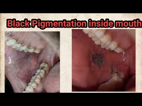 Black pigmentation inside mouth.Black pigmentation due to habit or due ...