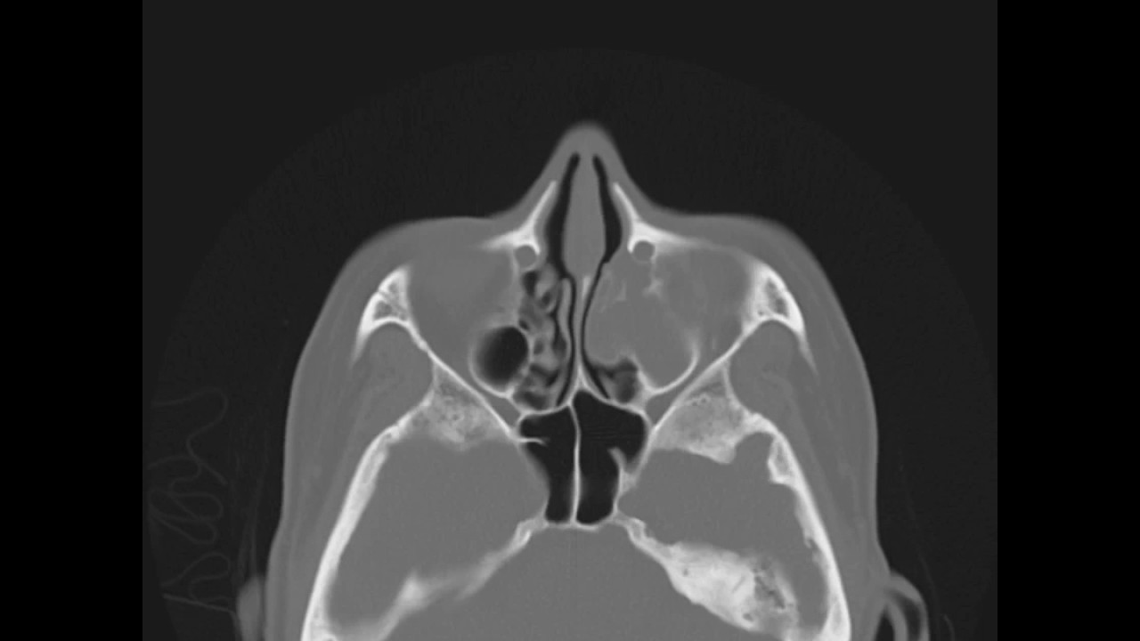 Nasal Polyps X Ray