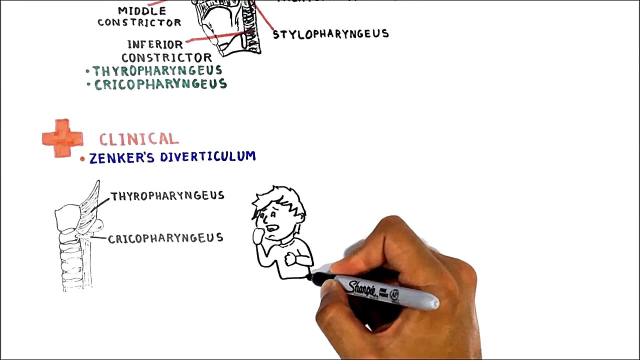 Zenker's diverticulum - YouTube