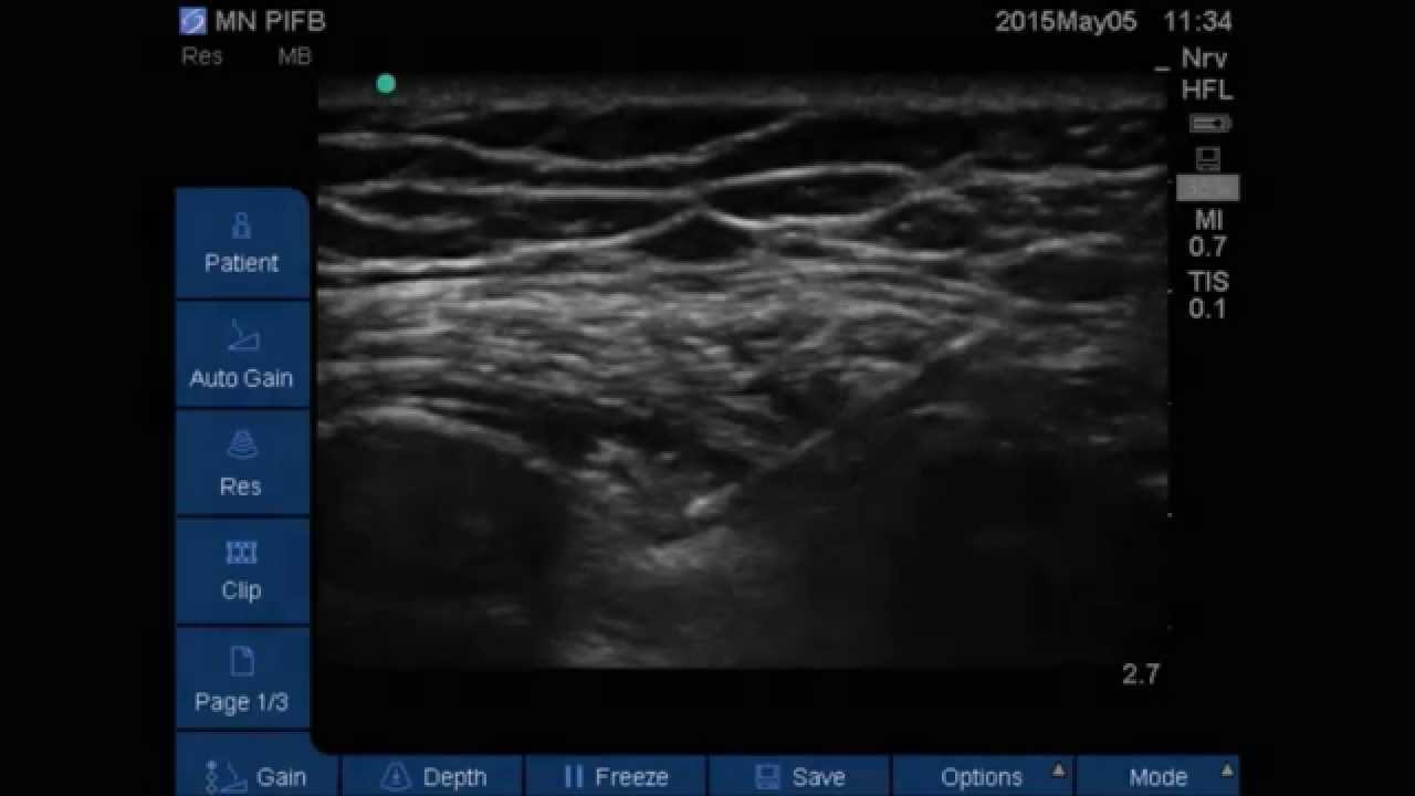 Subpectoral Interfascial plane block - YouTube