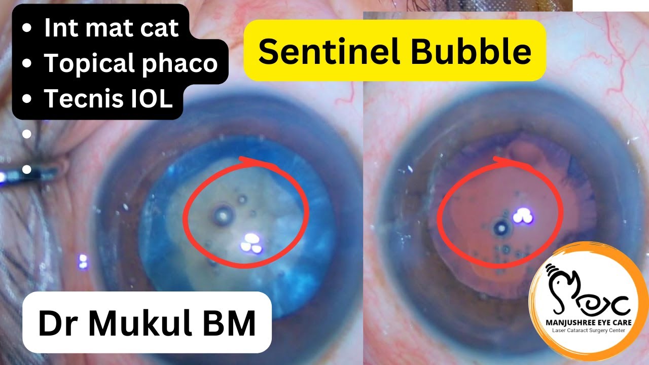 Sentinel bubble - Topical phaco | Int mat cataract | uncooperative ...