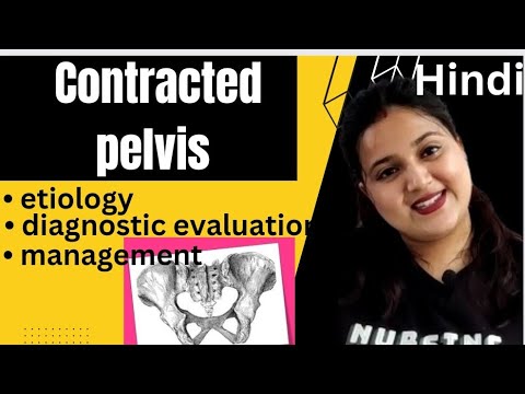 Contracted pelvis|| etiology|| Robert pelvis || Naegles pelvis ...