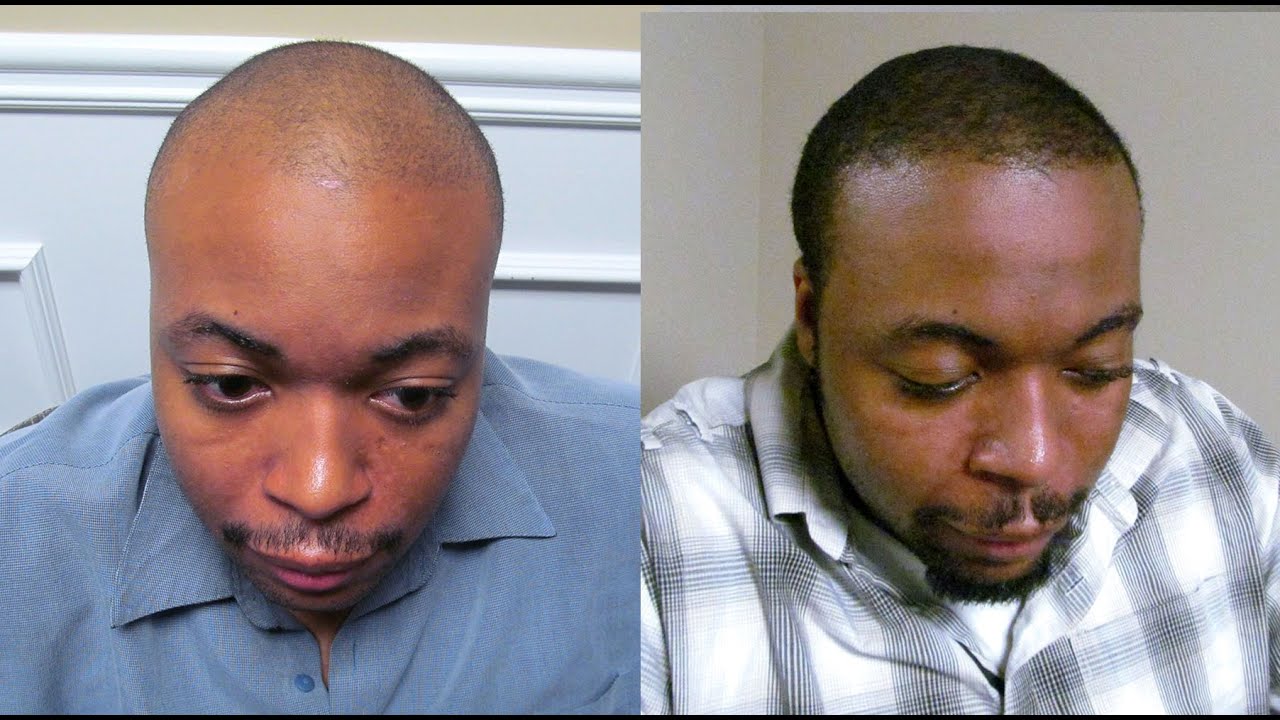 Top of the Head Reconstruction - Hair Restoration Specialists of ...