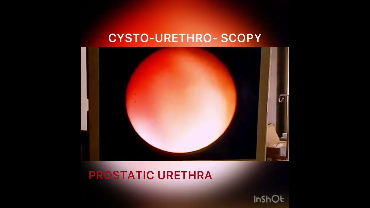 STRICTURE URETHRA - CYSTOSCOPY - URETHROSCOPY - YouTube